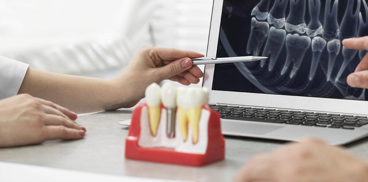 The Dental Implant Process: What to Expect from Beginning to End ...